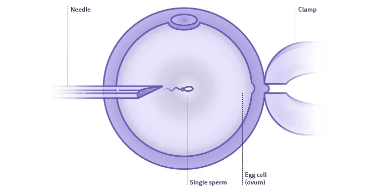 Apa itu inseminasi intra uterin? | MauPunyaAnak